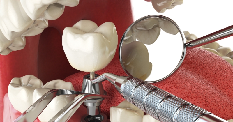 How Multi-Unit Implant Systems Simplify Full-Arch Restorations
